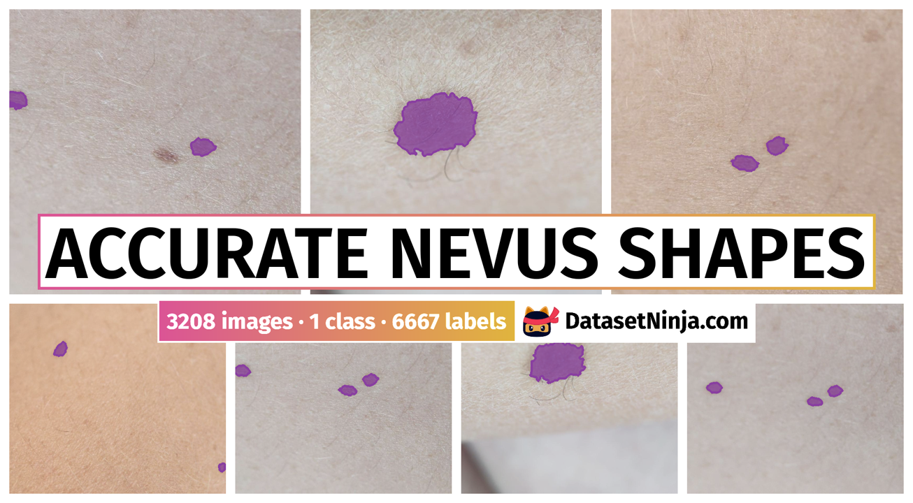 Accurate Nevus Shapes - Dataset Ninja