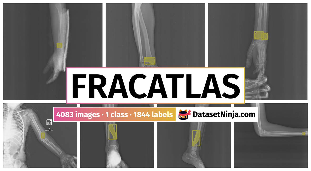 FracAtlas - Dataset Ninja