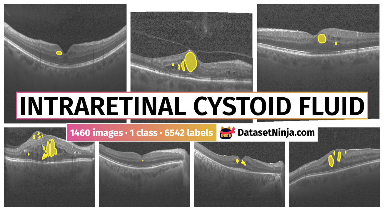 Intraretinal Cystoid Fluid - Dataset Ninja