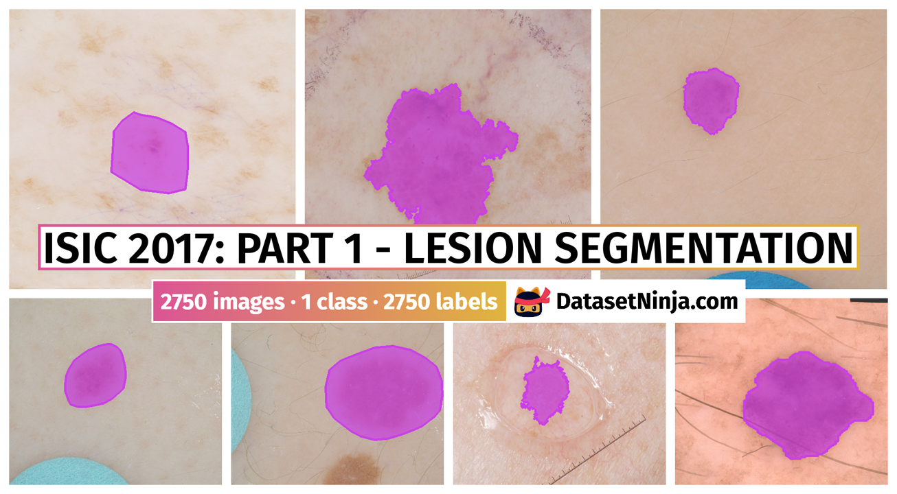 Isic 2017 Part 1 Lesion Segmentation Dataset Ninja