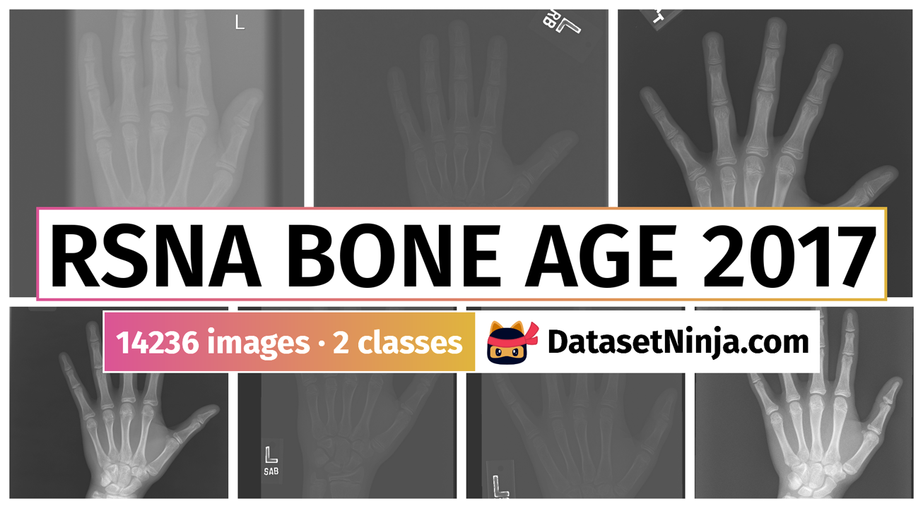 RSNA Bone Age 2017 - Dataset Ninja